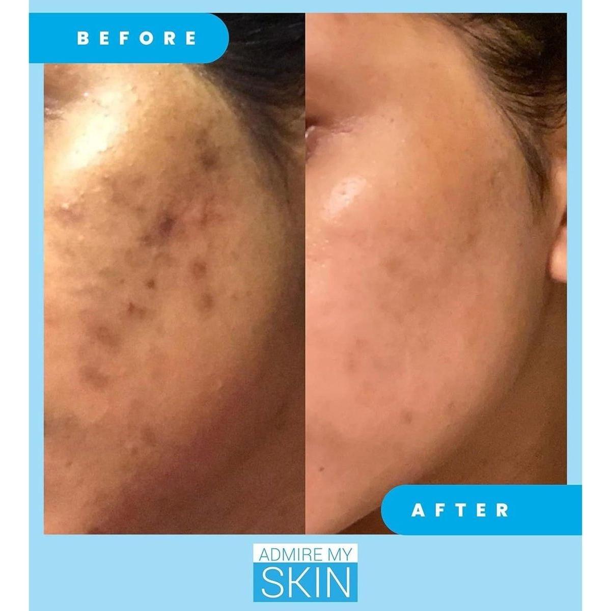 Admire My Skin Ultra Potent Brightening Serum – Advanced ...